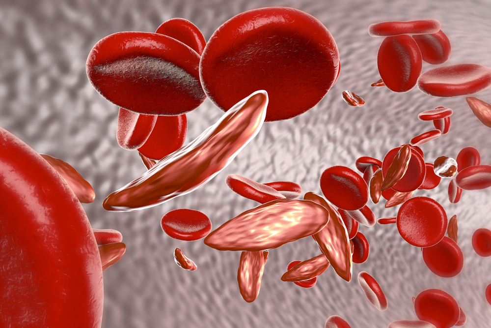 Sickle Cell Anemia Stems From Odd shaped Blood Cells Being Unable To 