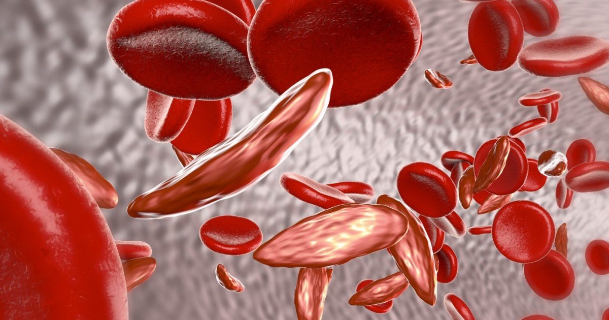 Abnormal Hemoglobin Assembly in SCD Fast, Inefficient, Study Finds
